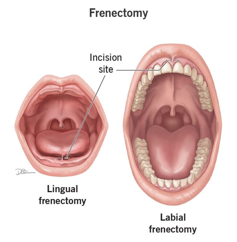 Frenectomy | Suguna Dental
